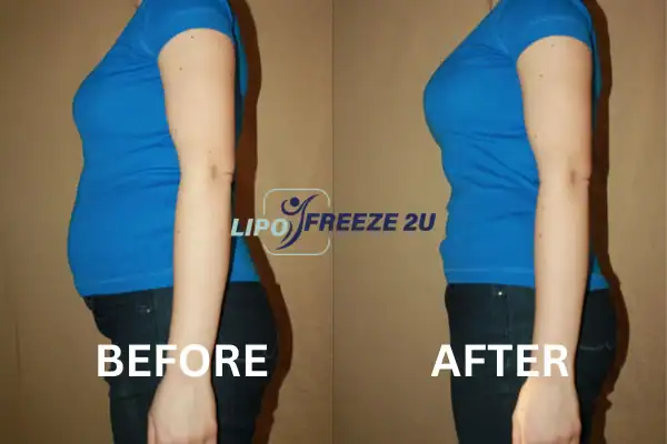 Fat Freezing Treatment Telford Non-Surgical Fat Reduction