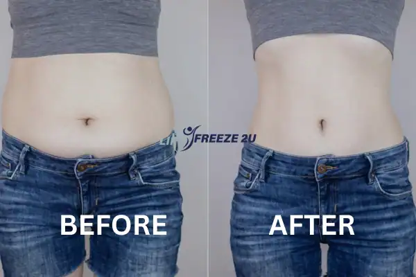 Fat Freezing Treatment Telford Non-Surgical Fat Reduction